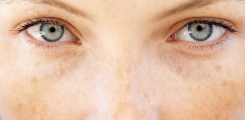 A skincare cheat sheet on how to get rid of hyperpigmentation