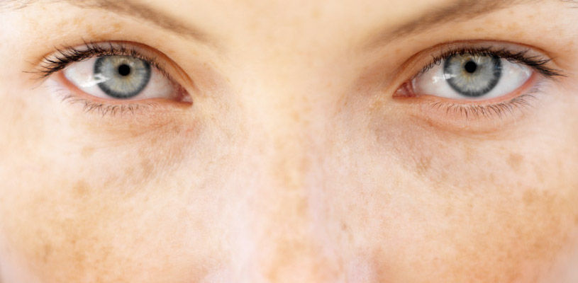 A skincare cheat sheet on how to get rid of hyperpigmentation