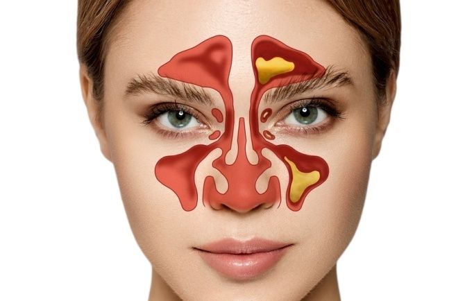 Cara mengatasi hidung tersumbat yang berkesan dan dijamin selamat