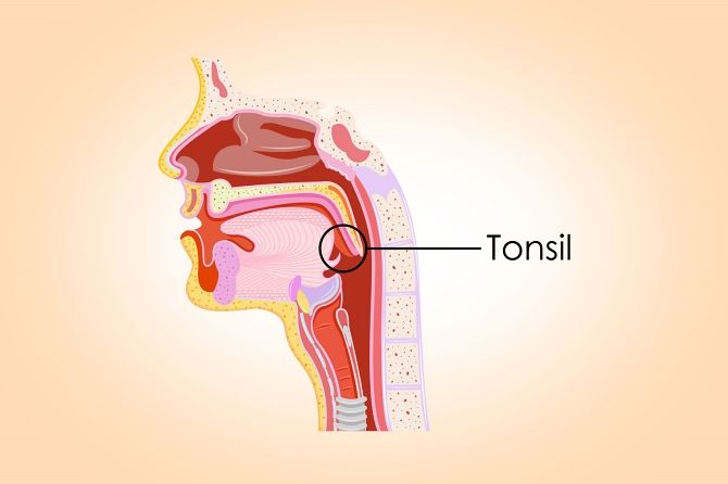 Tonsil bengkak: Ini yang anda patut tahu dan bila perlu jumpa pakar