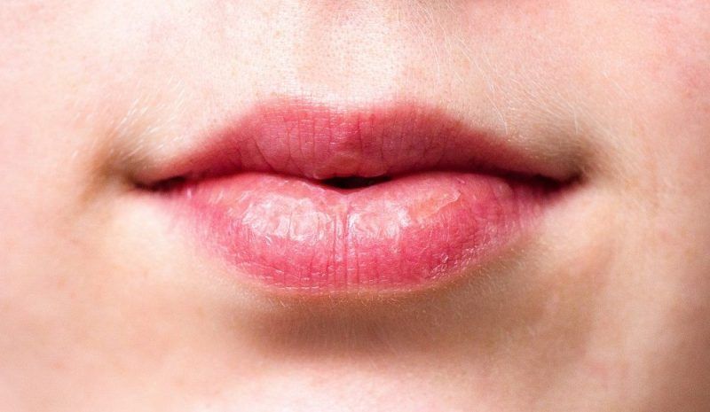 Dry lips causes and treatments, according to a doctor – Idiom Studio