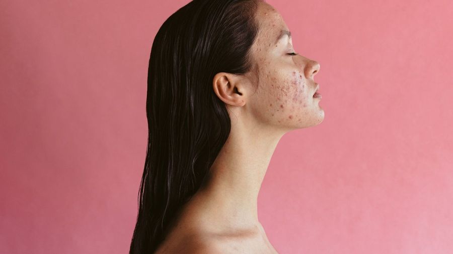 New acne treatment on the block: Is sunburn the way to get clear skin?