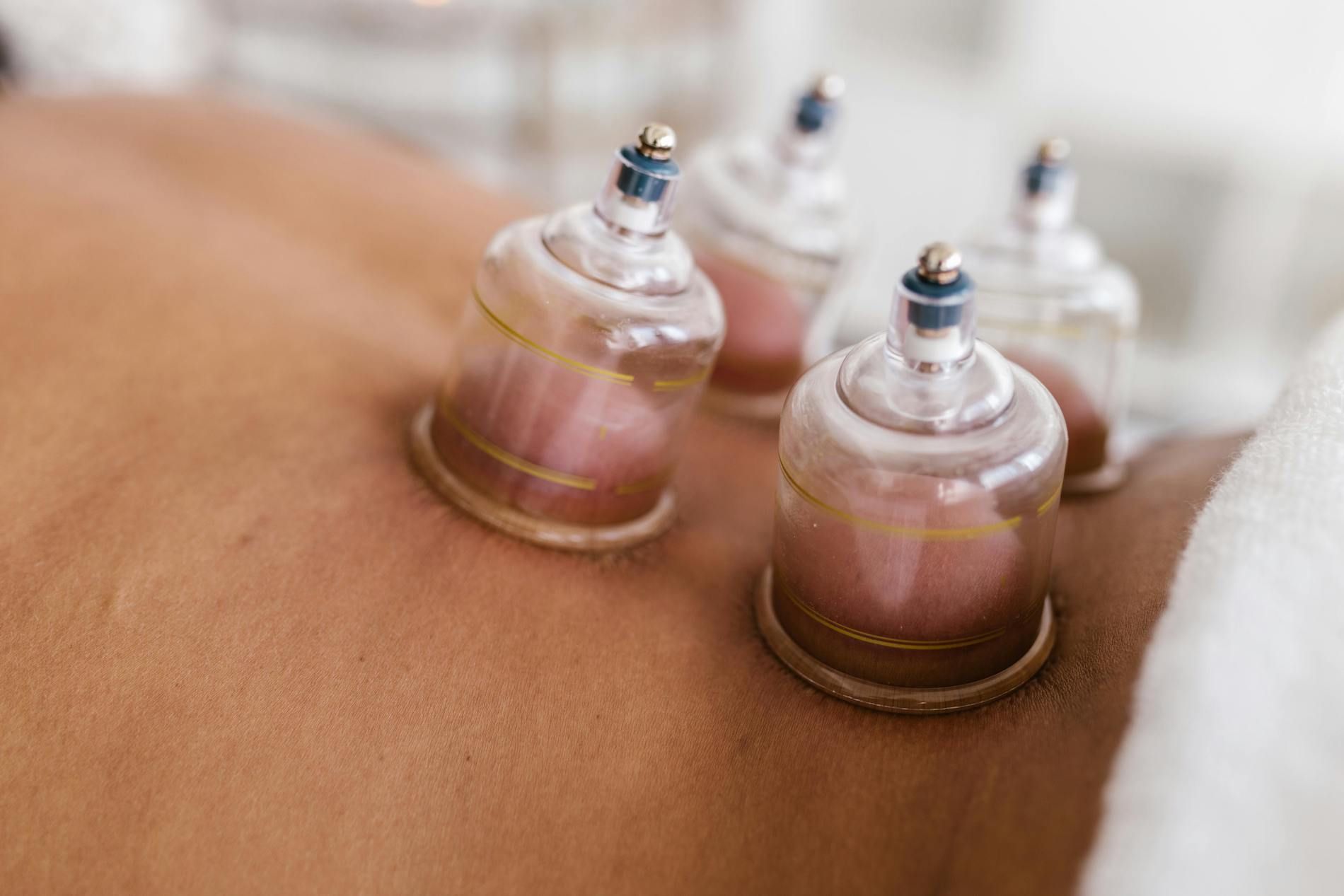 Cupping therapy benefits and more about the TCM wellness trend