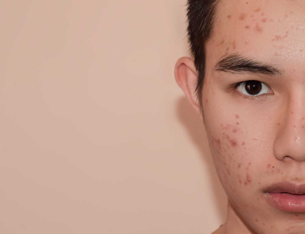 Common men's skin issues decoded by skin specialists and professionals