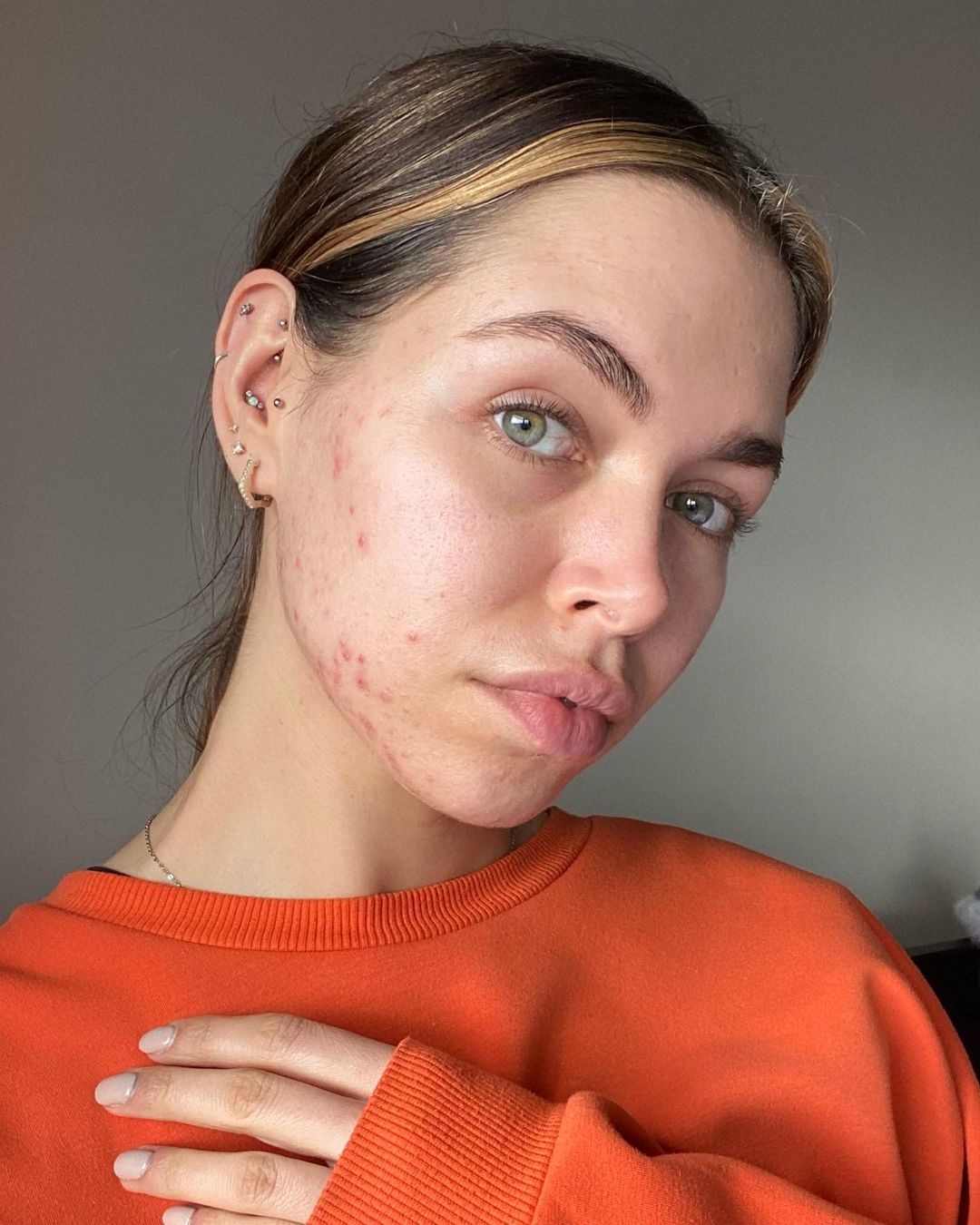 Busting common acne myths with facts