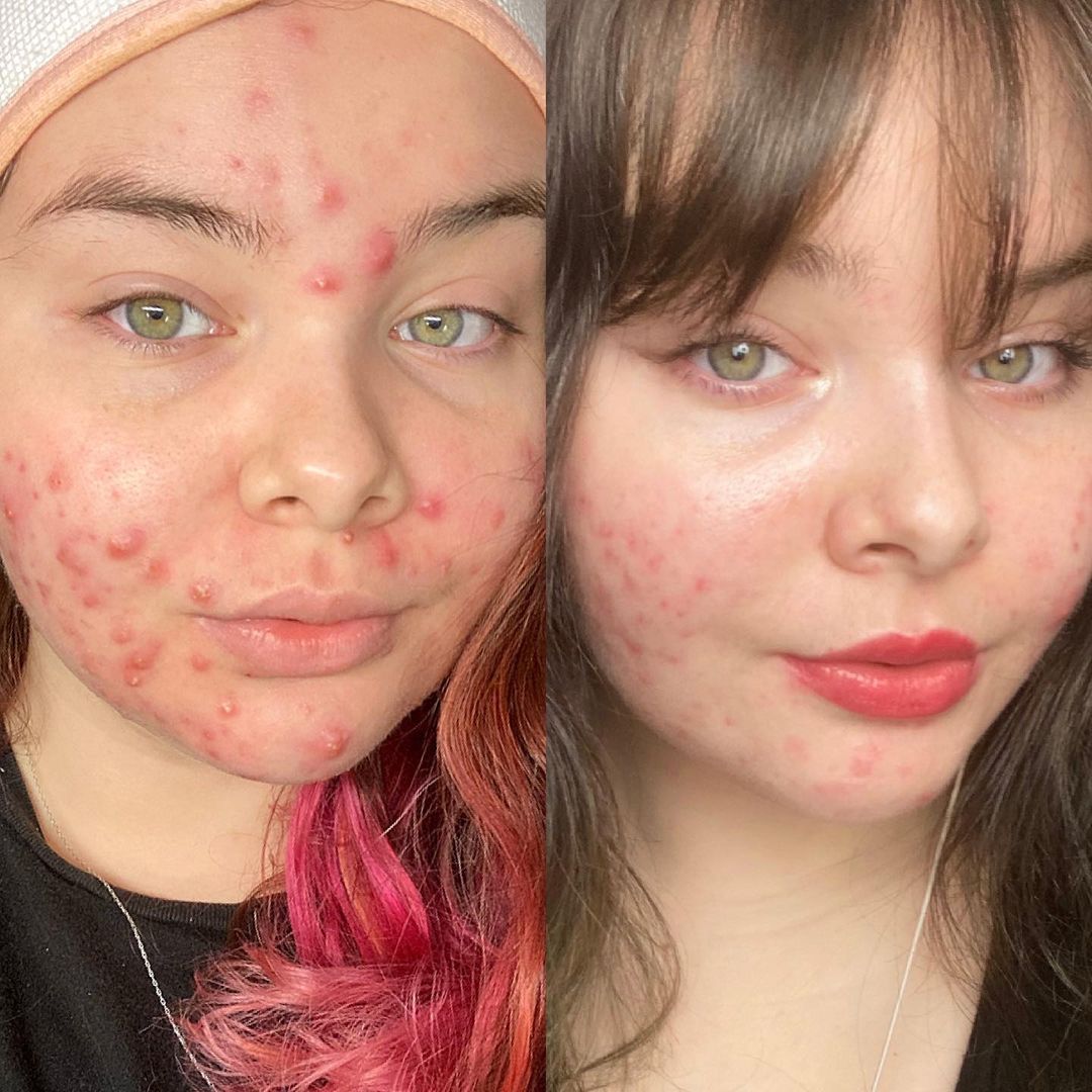 Busting common acne myths with facts