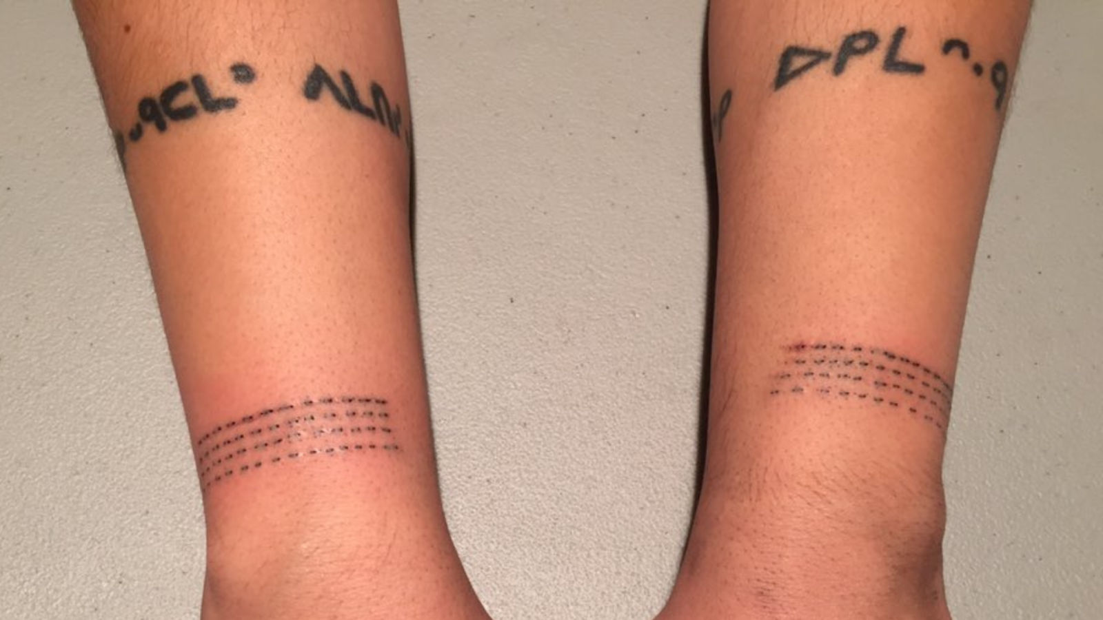 The resurgence of the ancient art of skin-stitch tattoos