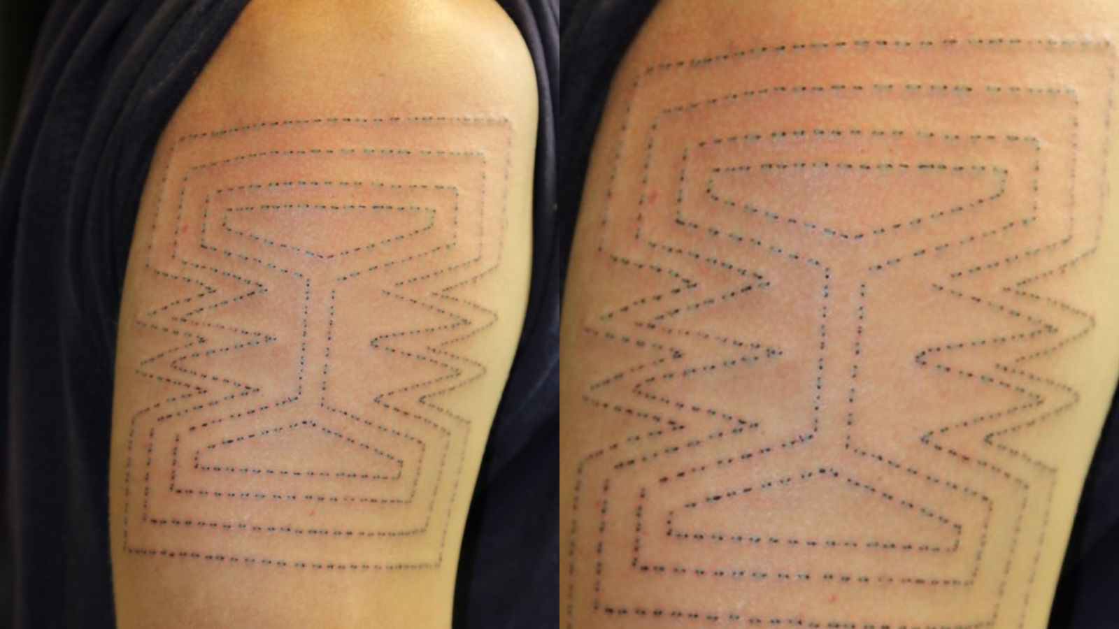 The resurgence of the ancient art of skin-stitch tattoos