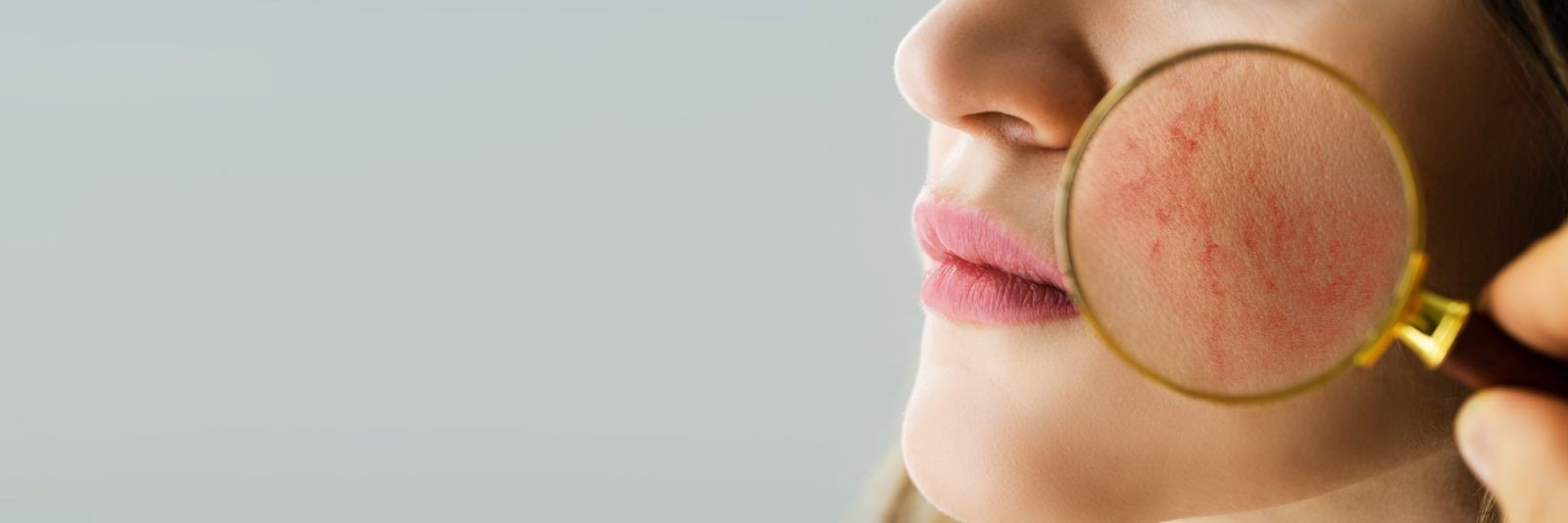 All you need to know about Rosacea and tips to deal with the same