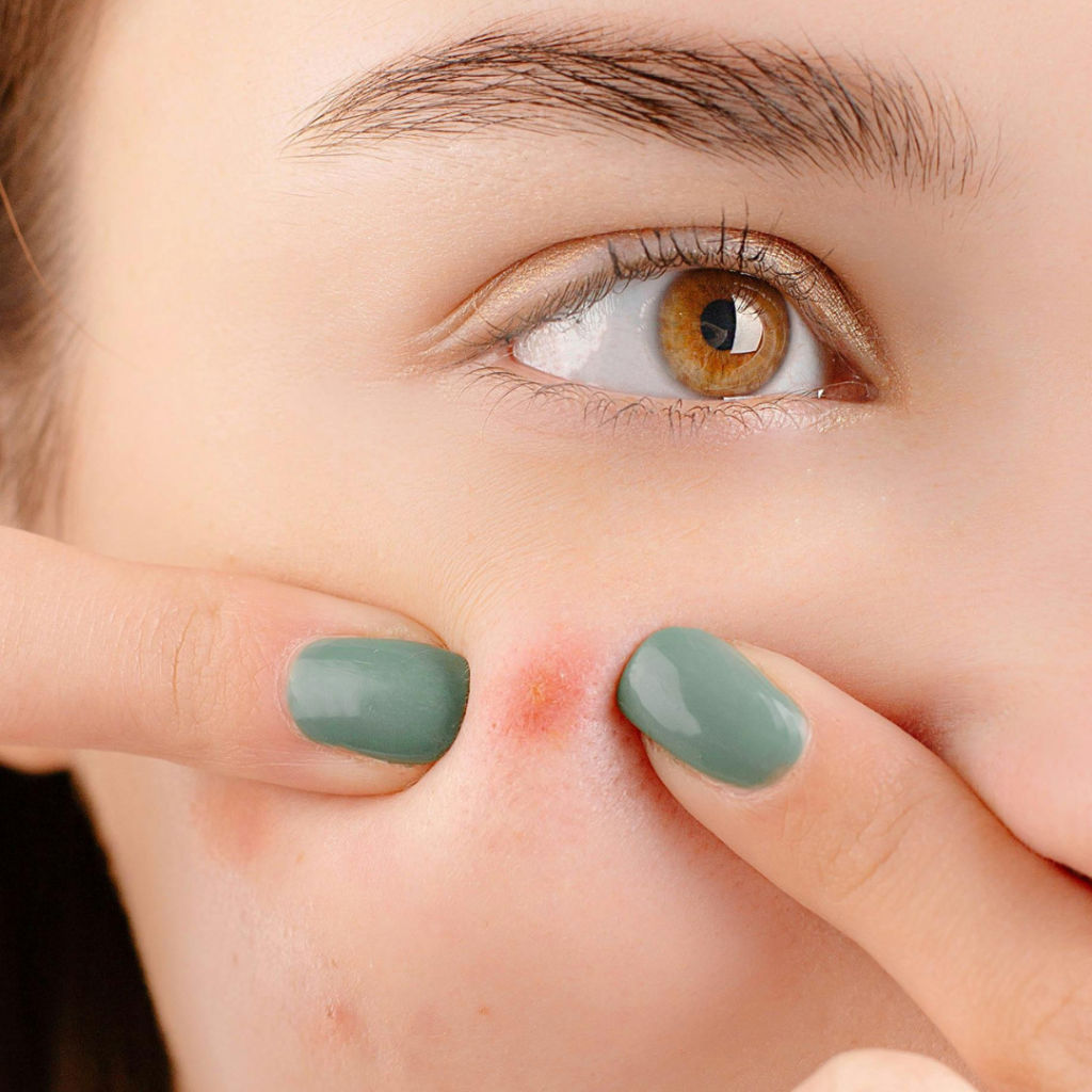 Is stress causing your acne? Discover expert solutions and insights